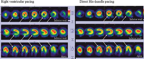 Example Of Spect The Arrows Indicate The Perfusion Defects Mainly
