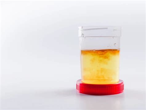 Uremia Causes Symptoms And Test