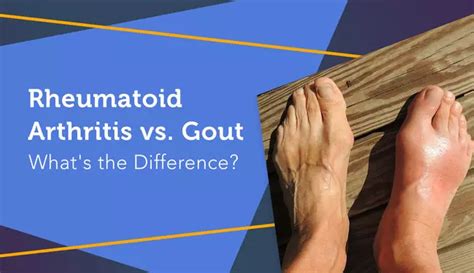 Rheumatoid Arthritis Vs Gout What Is The Difference Myrateam