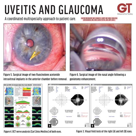 Glaucoma Today On Linkedin A 49 Year Old Man Presents For A Routine Glaucoma Today On Linkedin A 49 Year Old Man Presents For A Routine