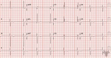 Right Bundle Branch Block Ecg Stampede
