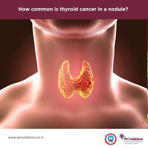 Thyroid Cancer No Nodules At Rae Downey Blog