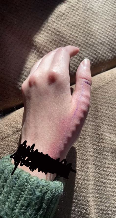 Thumb Ribssilicone Implants Rbodymods