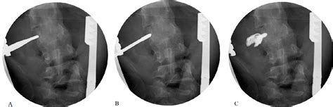 Figure 1 From Novel Screw Placement Method For Extremely Small Lumbar Pedicles In Scoliosis