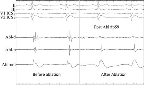 Example Of A Desirable Acute Ablation Effect On The Electrogram The Download Scientific