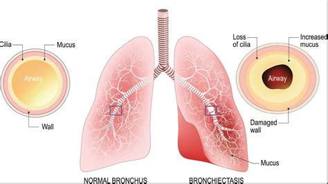 Bronchiectasis University Hospitals Sussex Nhs Foundation Trust