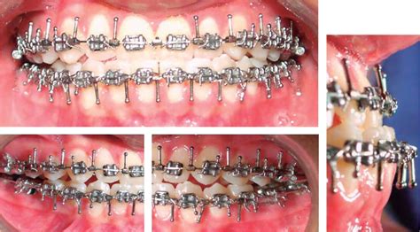 Skeletal Class Iii Correction By Advancing And Descending The Maxilla