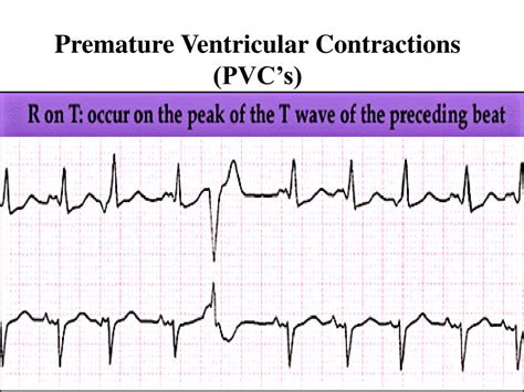 Understanding Premature Ventricular Contractions Cxxylx