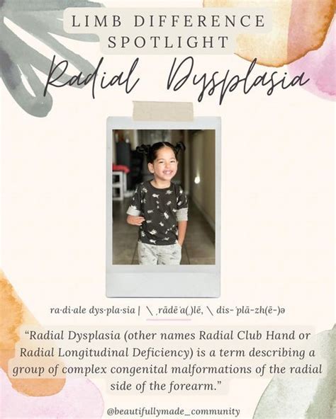 Beautifully Made Community On Instagram Limb Difference Spotlight Part 1 Radial Longitudinal