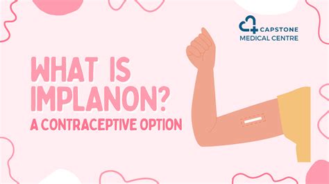 What Is A Contraceptive Implant Capstone Medical Centre Southbank