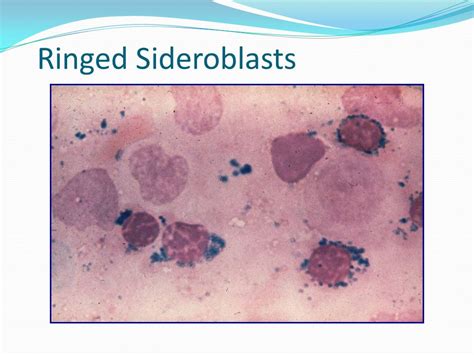 Myelodysplastic Syndrome Ppt Video Online Download