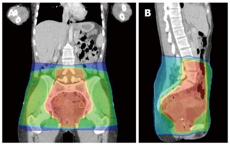 Lowering Radiotherapy Toxicities Following A Pelvic Cancer Diagnosis SIFSOF