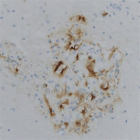 Cd10 Positive Immunohistochemistry Stain Cd10 Cluster Of Download Scientific Diagram