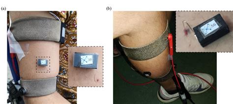 Figure From First In Human Demonstration Of Floating EMG Sensors And Stimulators Wirelessly