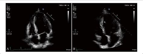 Transthoracic Echocardiography Revealed The Absence Of Left Ventricular