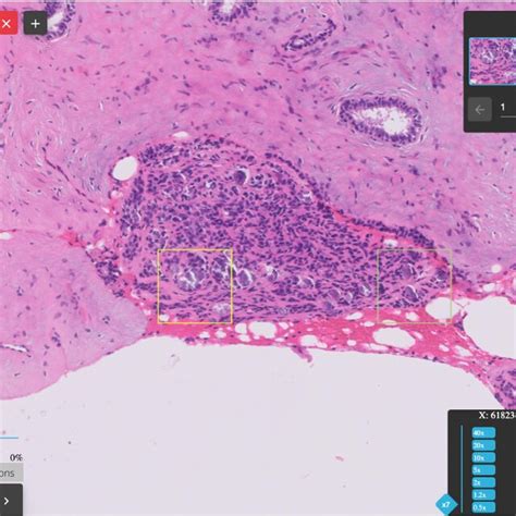 inference pipeline i detection of epithelial regions ii tiling