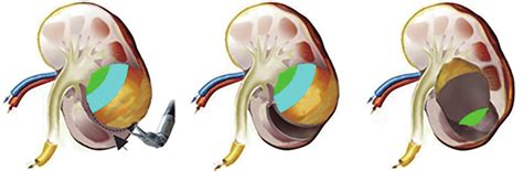 mrate procedure a the border of the complex renal tumor and the