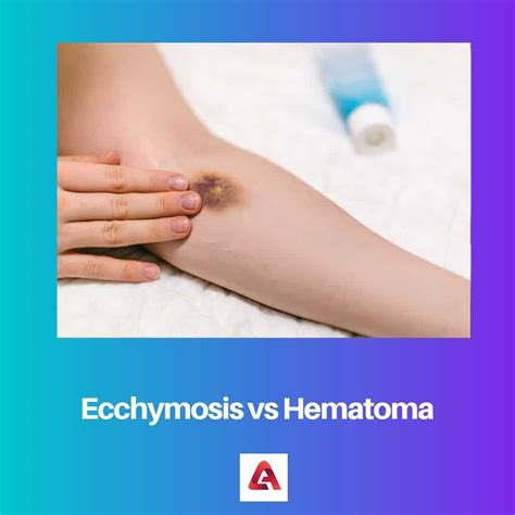 Ecchymose Vs Hématome Différence Et Comparaison