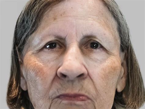 Drooping Eyebrows Eyebrow Ptosis The Elza Institute