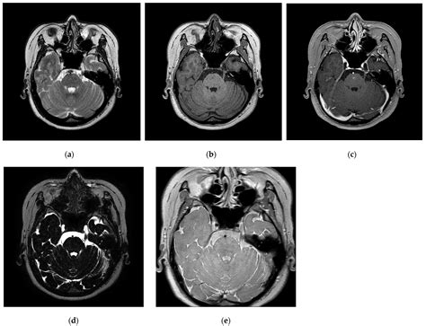 Deep Learning Super Resolution Technique Based On Magnetic Resonance Imaging For Application Of