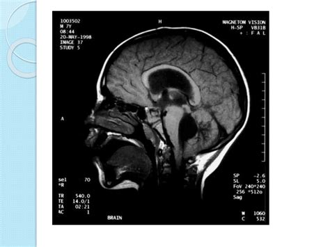 Normal Brain Ct Scan Vs Hydrocephalus Explained Pptx