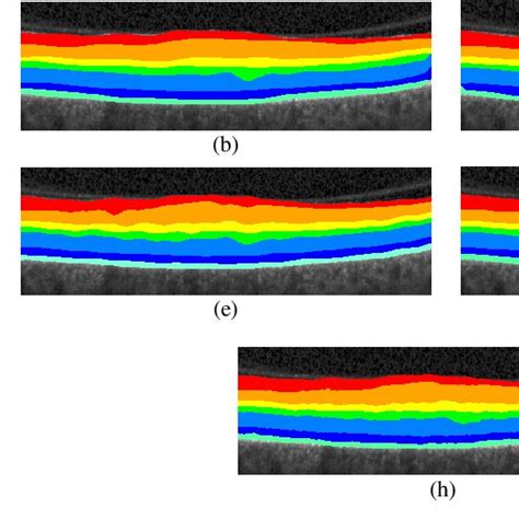 Layer And Fluid Segmentation Results On An Abnormal Oct B Scan Sample