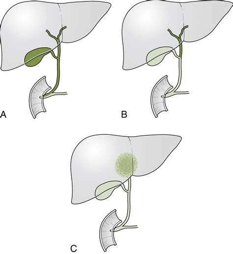 Endoscopic Retrograde Cholangiopancreatography Clinical Tree