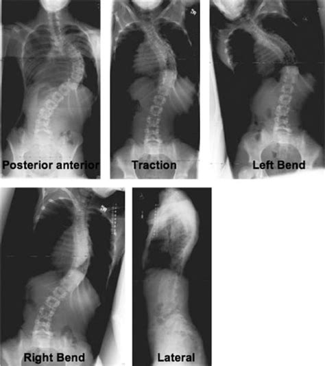 5 Clinical And Radiographic Evaluation Of The Scoliotic Patient Neupsy Key