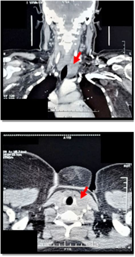 A Case Of Reversible Hypoparathyroidism In A Patient With Riedels Thyroiditis Treated With