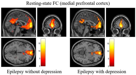 The Impact Of Resting State Functional Connectivity Alterations Due To