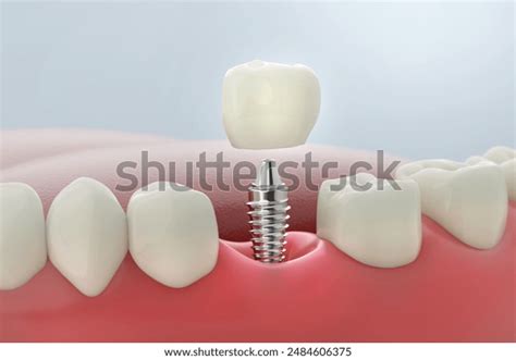 Single Dental Implant Molar Teeth 3d Stock Illustration 2484606375