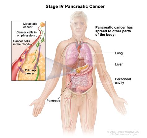 Pancreatic Cancer Treatment Pdq® Nci