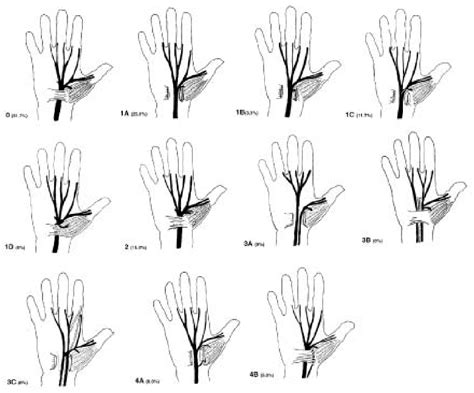 Figure 2 From The Anatomical Variations Of The Palmar Cutaneous Branch