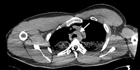 Post Mortem Ct And Mri Appropriate Post Mortem Imaging Appearances And