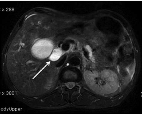 Magnetic Resonance Imaging Of A Patient Showing Bile Duct Dilation