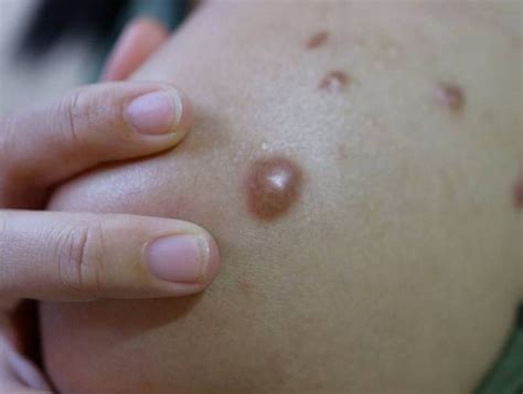 БНЭУ д сармагчны цэцэг өвчний сэжигтэй тохиолдол бүртгэгдэв E Mn