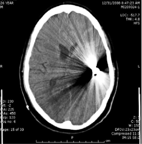 A Head Computed Tomography Scan Without Contrast Showing Large Bullet