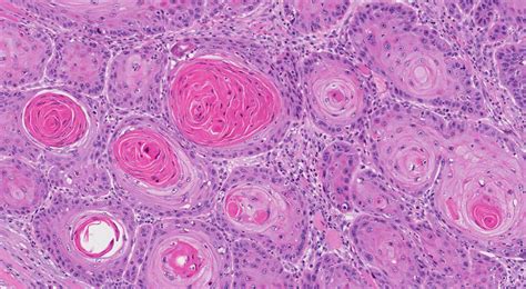 Oral Squamous Cell Carcinoma Histology