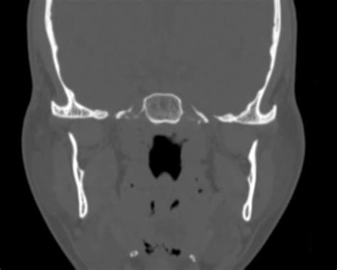 Radiopaedia Case Odontogenic Maxillary Sinusitis Id 67424 Study 76813
