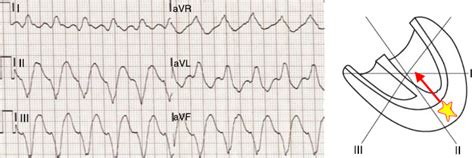 AVR Algorithm Vereckei ECG Book