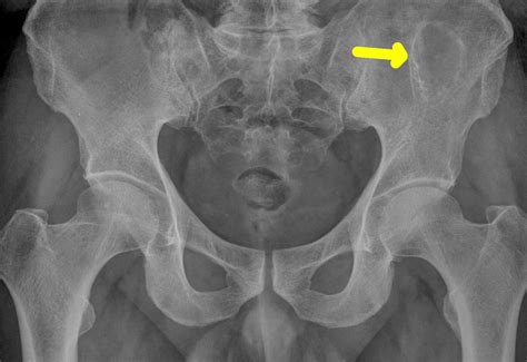 Chronic Subperiosteal Hematoma Of The Iliac Bone Eurorad