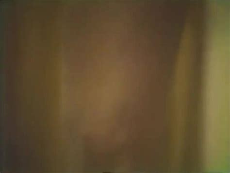 Amputee Prosthetic Fitting