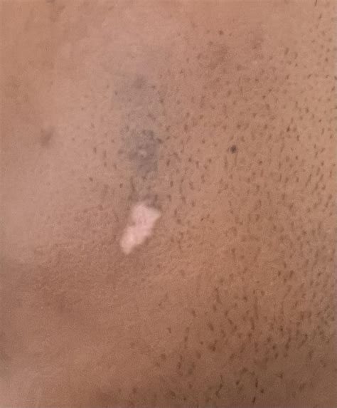 Insect Bite Scab On Face Rskincareaddicts