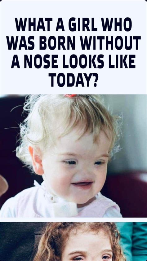 What The Noseless Girl Looks Like Nowadays Echo News