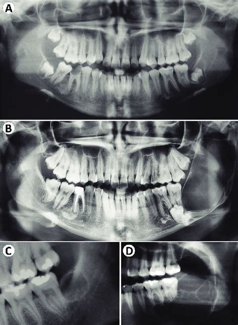 Ameloblastoma Who Classification 2017 At Joel Norris Blog