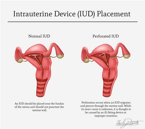 Intrauterine Device