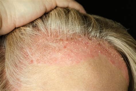 Psoriasis Gejala Penyebab And Cara Mengobati