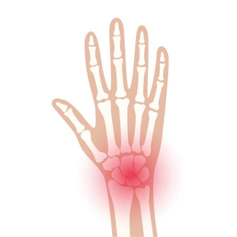 Arthritis In Fingers Backgrounds Illustrations Royalty Free Vector