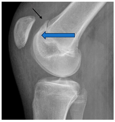 Patellofemoral Instability In The Pediatric And Adolescent Population