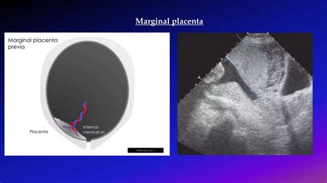 Ultrasound Imaging Of Placenta Pptx